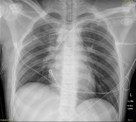 Figure 3 From Subcoracoid Acromioclavicular Joint Dislocation Rockwood Type Vi Sustained In