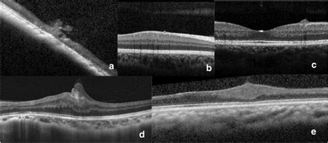 A Sd Oct Of Case 8 Showing A Peripheral Retina Tuft B Sd Oct Of Case 5