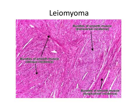 Ppt 3 Leiomyoma Powerpoint Presentation Free Download Id2234658
