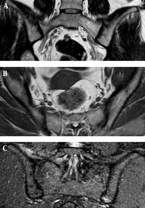 Sacroiliac Joints Inflammation Present With Bone Marrow Edema In The Download Scientific