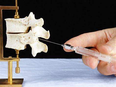Epidural Steroid Injection Benefits Risks Results And More
