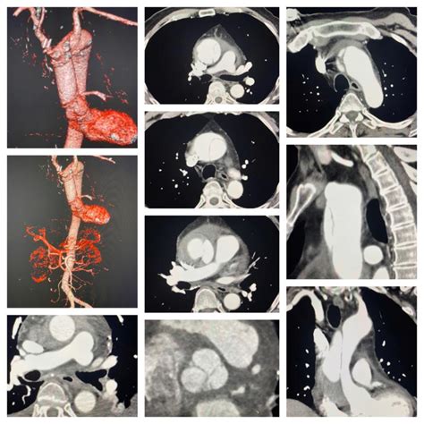 Kim De La Cruz Md Facs Facc Fccp On Linkedin Acute Debakey Type Ii Aortic Dissection With Mild