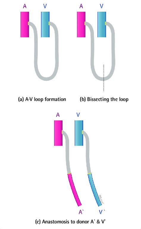 Schematic Representation Of An Arteriovenous Loop A V Loop