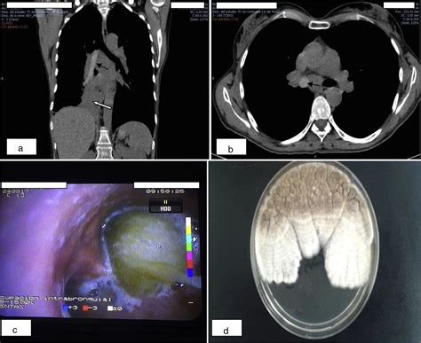 Radiology Bronchoscopy And Microbiology In Bronchopulmonary