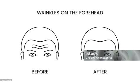 이마의 주름 시술 전과 벡터에 치료 라인 아이콘을 적용한 후의 레이저 미용 매끄럽고 깨끗한 피부와 주름을 가진 남자의 그림 이마에 대한 스톡 벡터 아트 및 기타 이미지