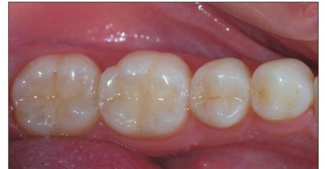 Figure 12 Modified Matrix Band Design For