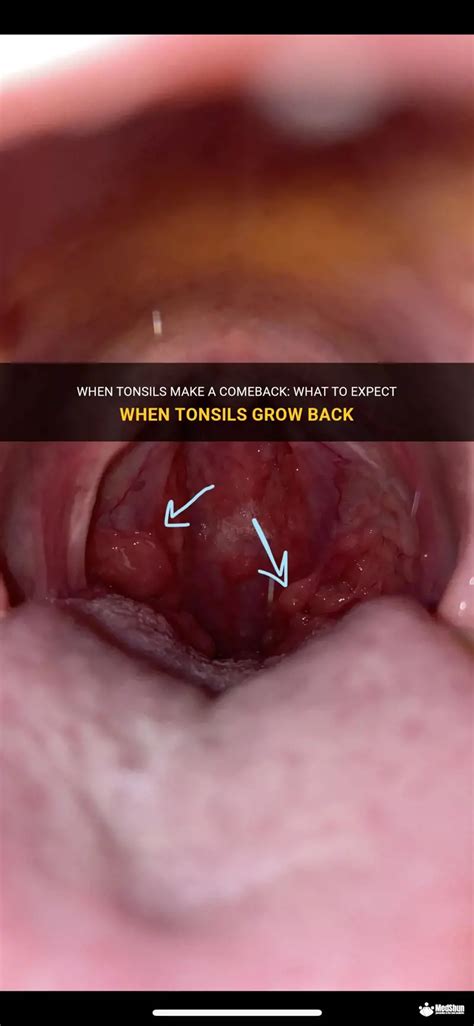 When Tonsils Make A Comeback What To Expect When Tonsils Grow Back