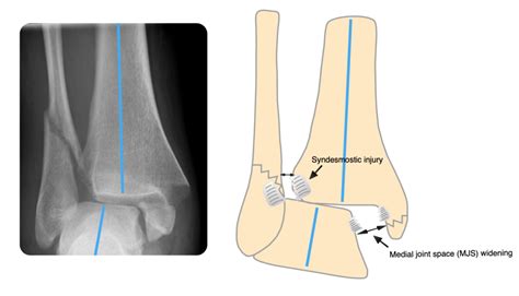 Ankle Fractures Orthosho