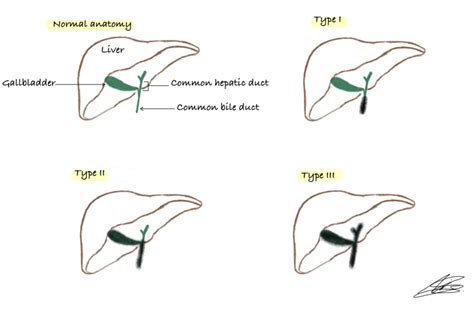 Gold Standard Test For Biliary Atresia At Darrell Coria Blog