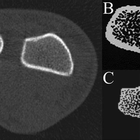 Original Peripheral Quantitative Computed Tomography Pqct Image And Download Scientific