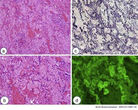 Pleuroparenchymal Fibroelastosis Is It Also An Idiopathic Entity