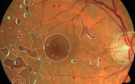 Improving Retinal Screenings Of Patients By Neural Networks Training