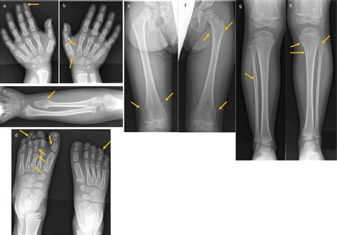 Radiographs Of Proband Ab Multiple Bilateral Metacarpal And Download Scientific Diagram