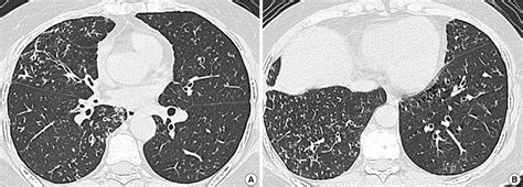 Single Center Experience Of Five Diffuse Panbronchiolitis Patients Clinically Presenting As