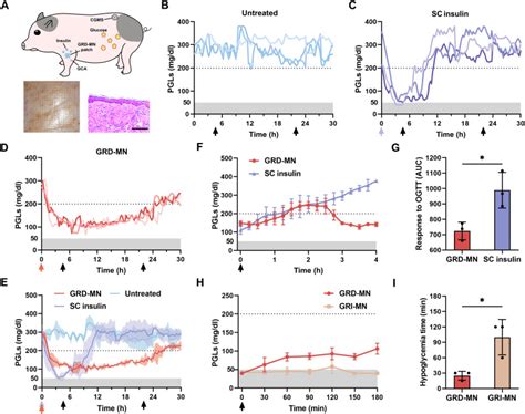Glucose Responsive Microneedle Patch For Closed Loop Dual Hormone