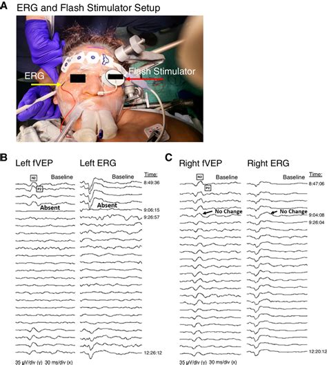 Erg Co Monitoring With Fveps Identifies False Positive Waveform