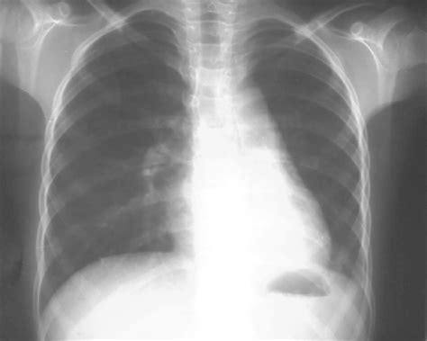 Postoperative X Ray Chest Showed Improvement Of Lung Aeration But Download Scientific Diagram