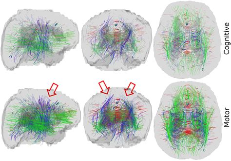 Preterm Infant Structural Connectome Subnetworks Best Predictive Of