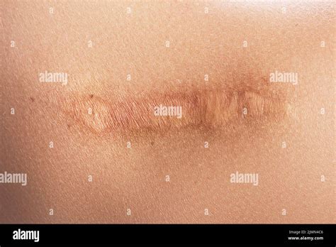 Female Shoulder With A Scar After Surgery Stock Photo Alamy
