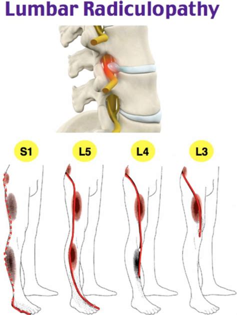 Myotomes Of The Spinal Cord Each Segmental Nerve Root Artofit