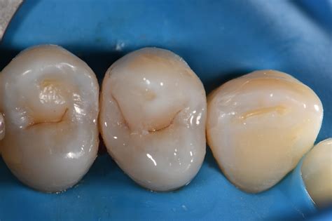 Composite Class Ii Restoration Composite Class Ii Restoration