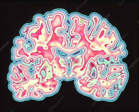 Ct Scan Of Brain Stock Image P Science Photo Library