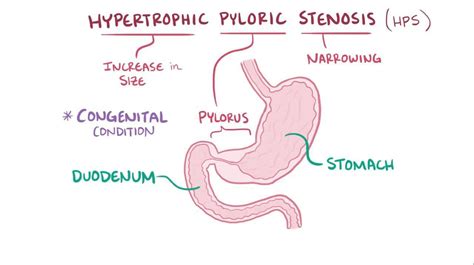 Pyloric Stenosis Video Anatomy Definition And Function Osmosis