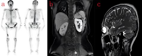Scalp Metastasis After Breast Cancer Surgery A Case Report Ott