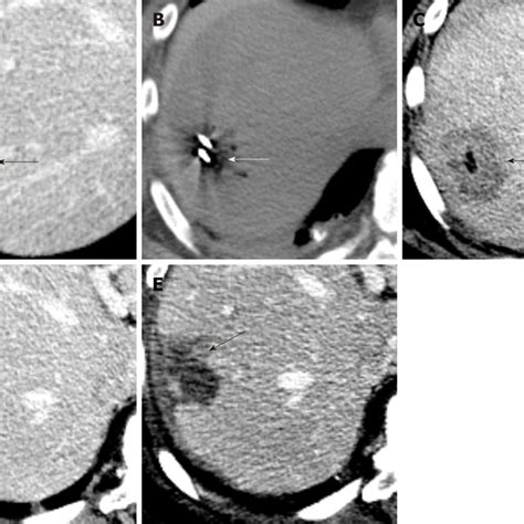 Fluoroscopic Image Showing Bismuth Type Iiia Hilar Stricture Download Scientific Diagram