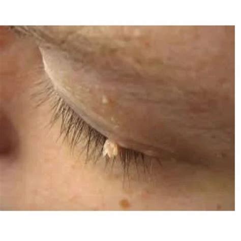 Warts Treatment In Homeopathy At ₹ 2500pack In Noida Id 25959816412