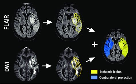 An Example Patient With Left Sided Cerebral Ischemia On The Right Side Download Scientific