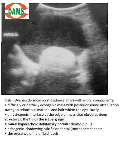 Ovarian Dermoid Ultrasound Teaching File Sumer S Radiology Blog