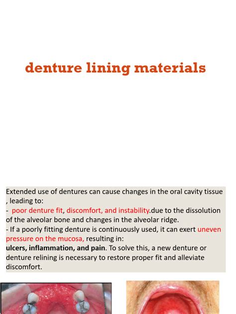 Denture Lining Materials 5 Pdf Dentures Polymethyl Methacrylate