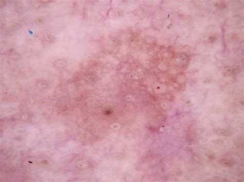 Skin Disease Classification Object Detection Dataset And Pre Trained Model By Susanth