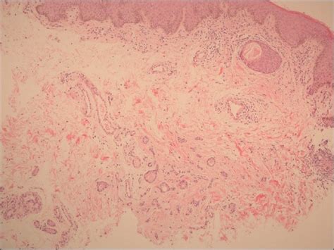 Multiple Brownish Papules On The Penile Shaft Indian Journal Of