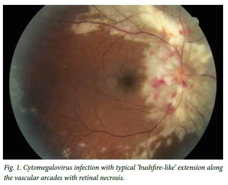 Cmv Retinitis Hiv