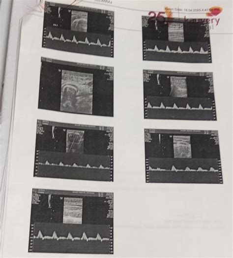 Comprehensive Management Of Diabetic Cellulitis In Hand And Its Outcome