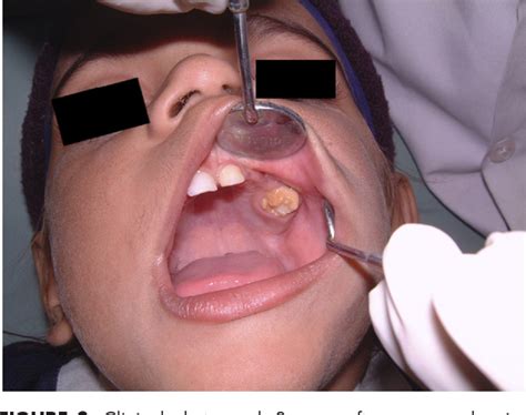Melanotic Neuroectodermal Tumor Of Infancy