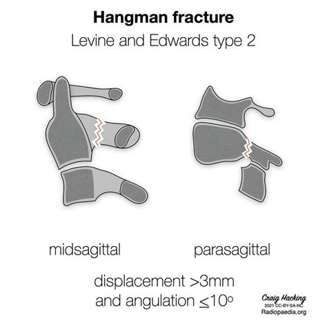Radiopaedia Case Levine And Edwards Classification Of Hangman Fractures