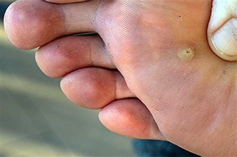 Flat Warts On Feet