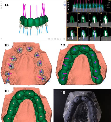 a b endodontic access cavities planned with the computer aided static