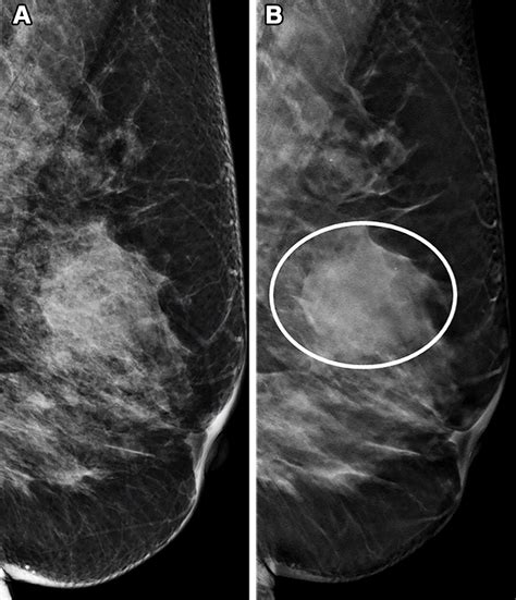 Breast Cancer In Dense Breasts Detection Challenges And Supplemental