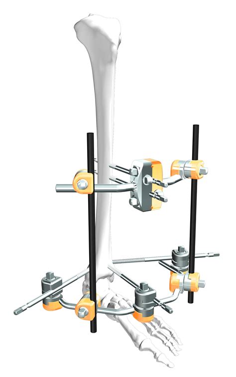 Orthopedic Trauma Implant Medical Device Dissection IV Φ 5 Children S Tibia External Fixation