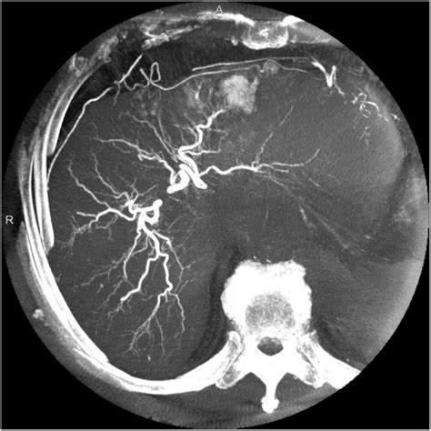 Interventional Oncology Procedures Siemens Healthineers España