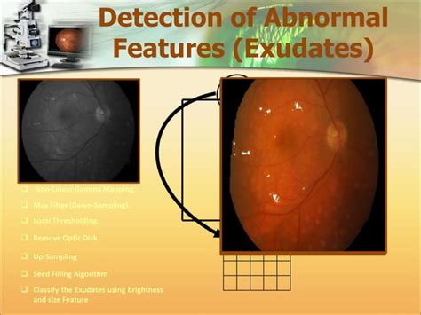 Automatic Detection Of Diabetic Maculopathy From Fundus Images Using Image Analysis Techniques Ppt