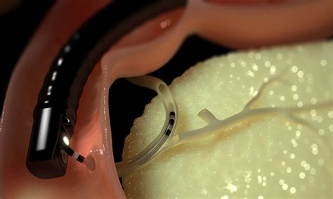 Ercp Nedir Prof Dr Cengiz Pata