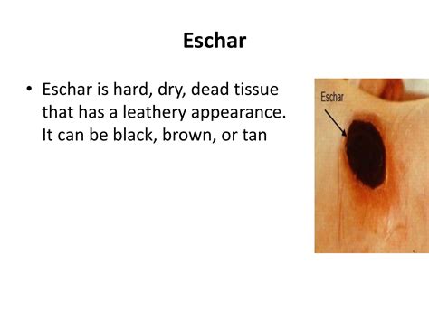 Pressure Ulcers A Decubitus Ulcer Stages Of Bedsore Pdf
