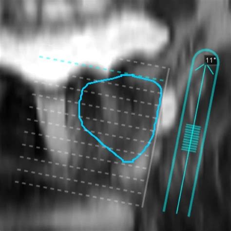 New Software Combines Pre Op Mri Guidance With Live Ultrasound For