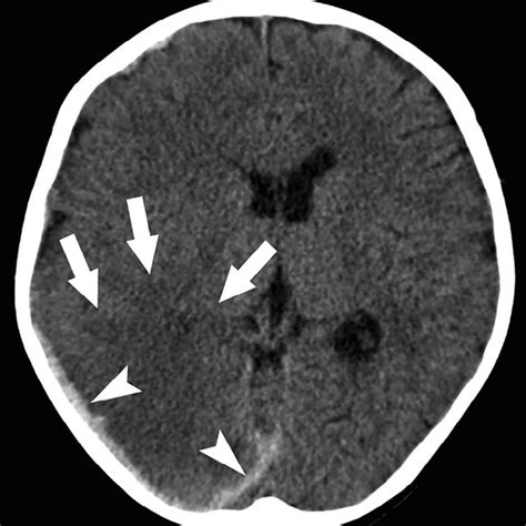 PDF Unilateral Anoxic Brain Injury Secondary To Strangulation Identified On Conventional And