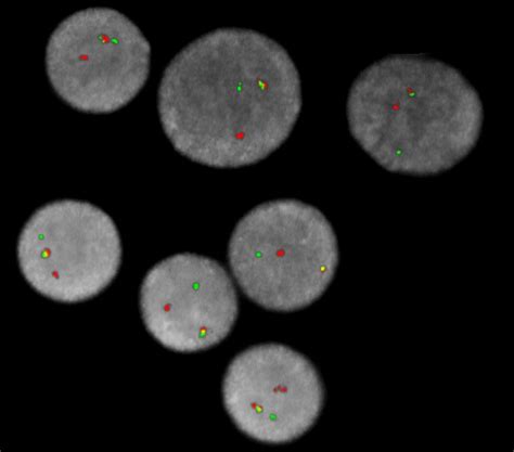 Cl T1517 Pmlrara Sf Translocationsingle Fusion Probe